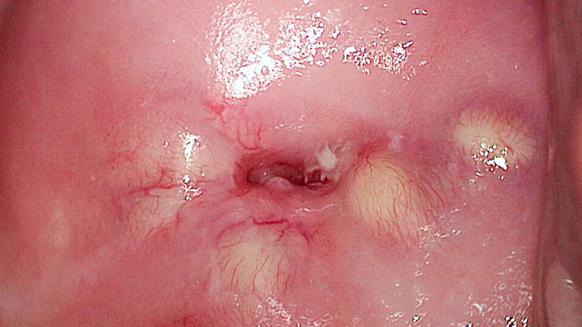 Nang Naboth cổ tử cung là gì? Dấu hiệu nhận biết? Nguyên nhân và cách phòng ngừa - An Phuc